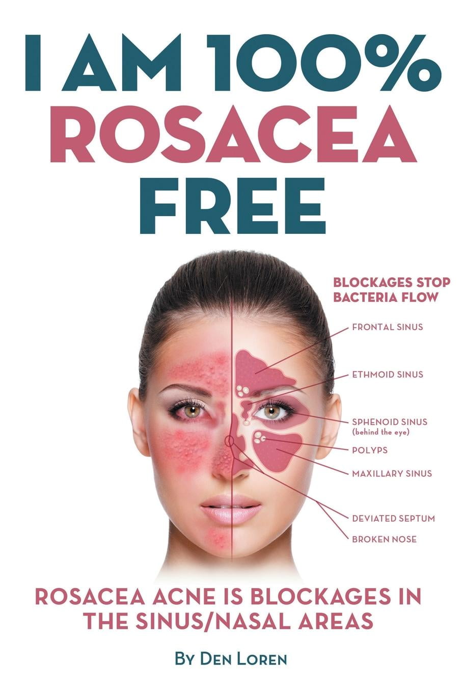 I Am 100% Rosacea Free: Rosacea Acne Is Blockages in the Sinus/Nasal ...