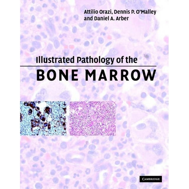 Illustrated Pathology of the Bone Marrow, (Hardcover) - Walmart.com