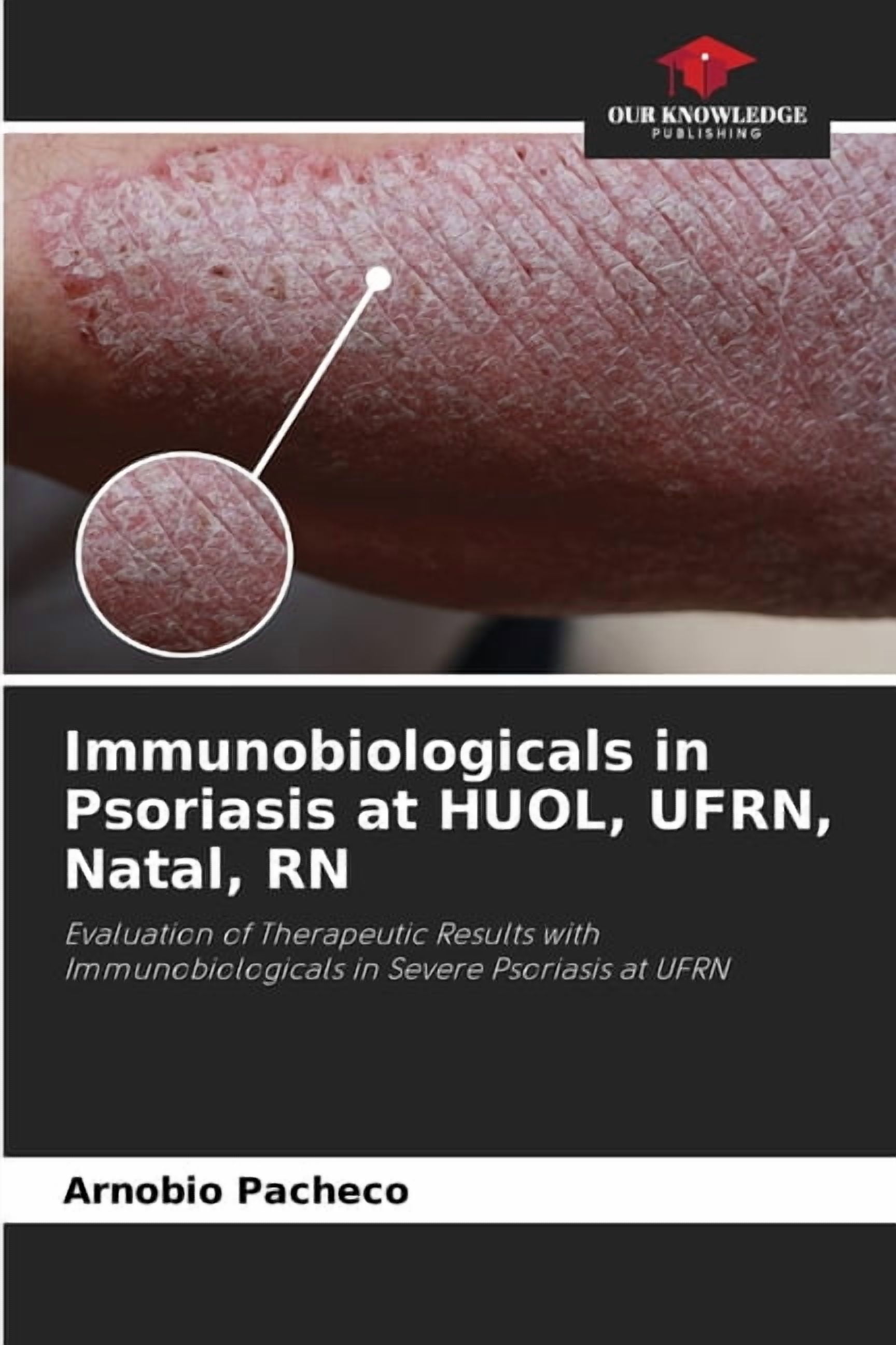 Immunobiologicals in Psoriasis at HUOL, UFRN, Natal, RN, (Paperback ...