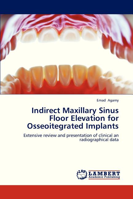 Indirect Maxillary Sinus Floor Elevation for Osseoitegrated Implants ...
