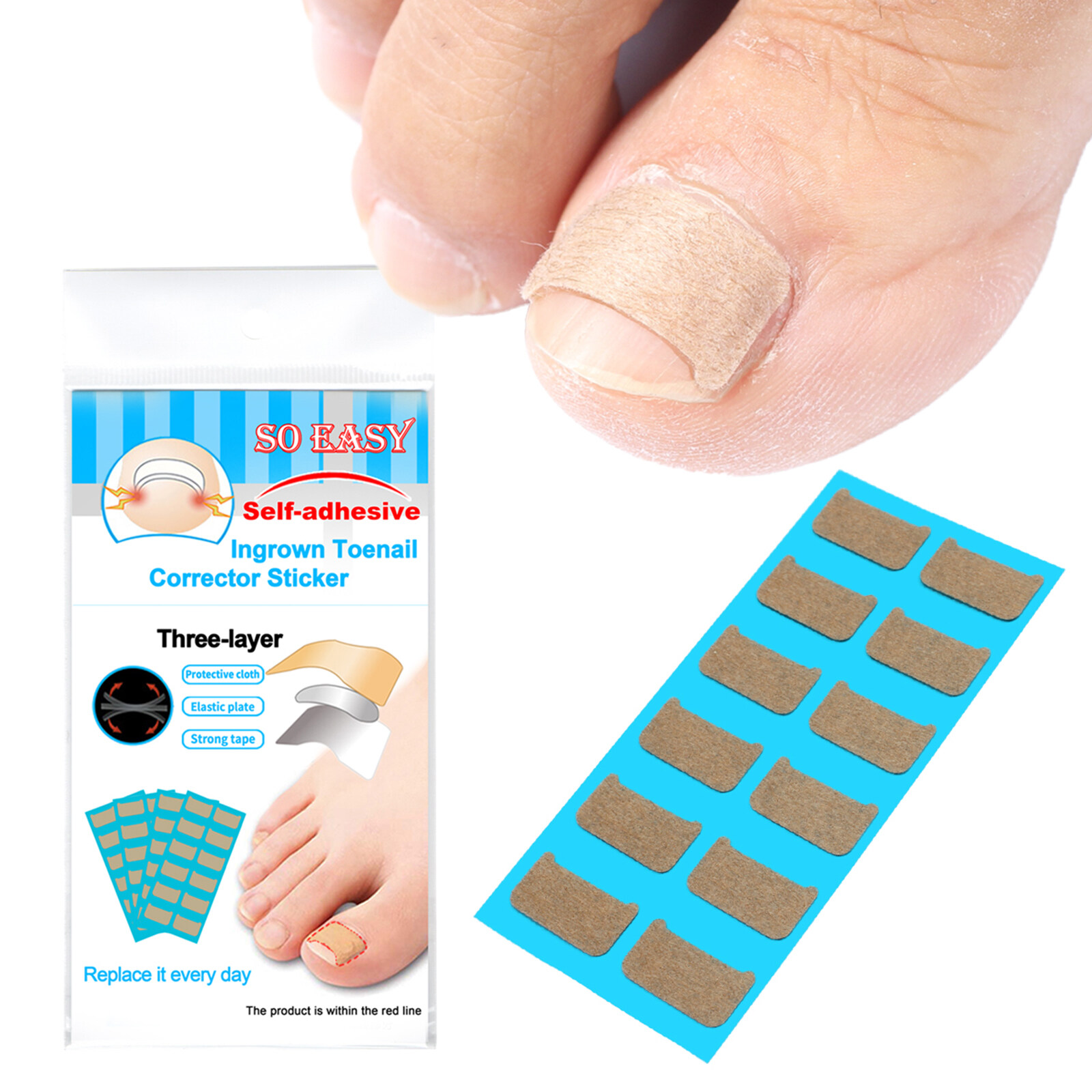 Ingrown Nail Correction Kit Ingrown Toenail Stickers Straightening ...