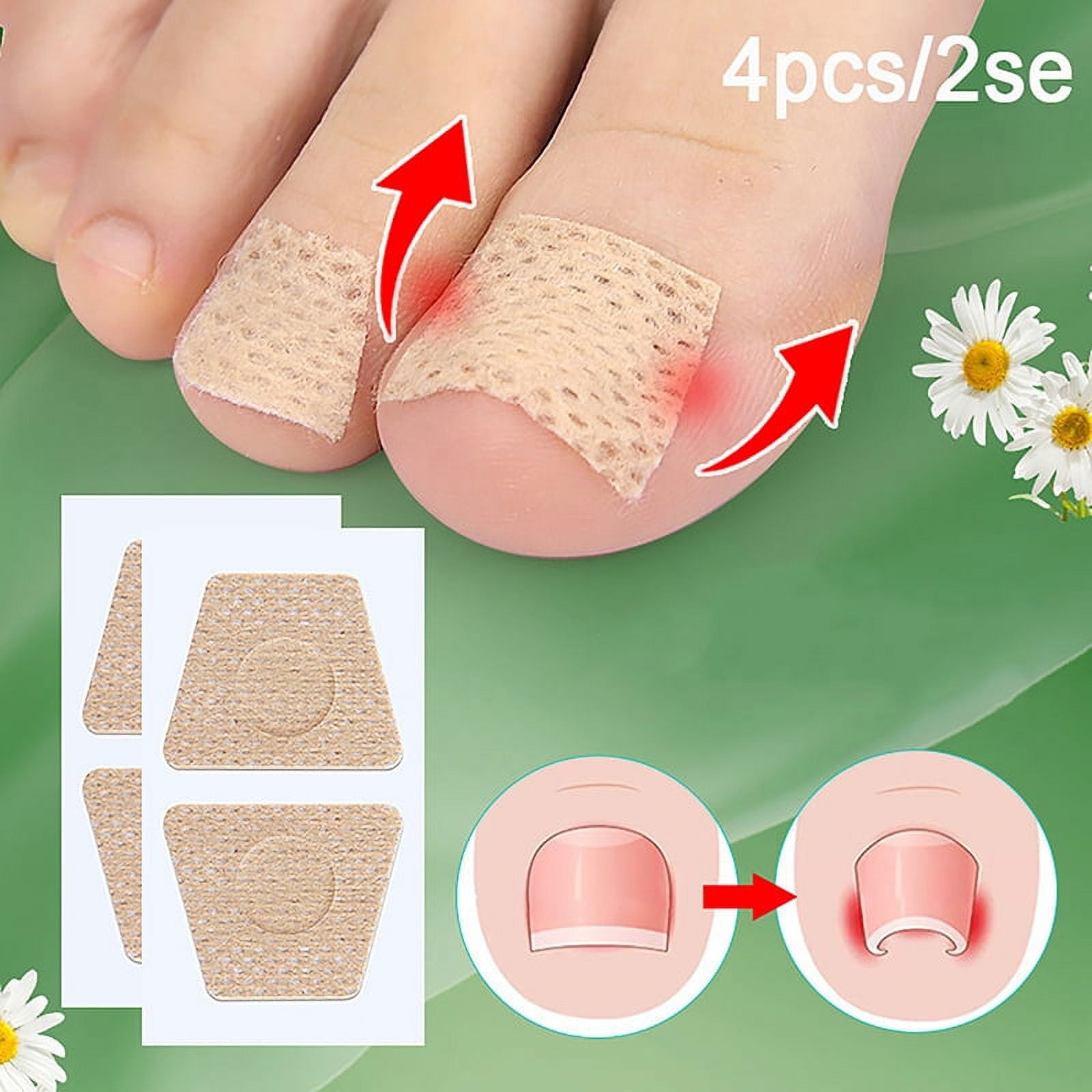 Ingrown Toenail Correction Anti Paronychia Treatment Toe Nail Sticker ...