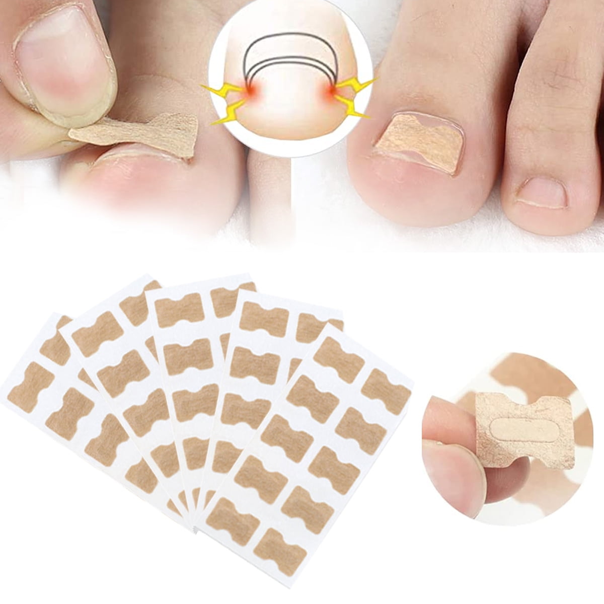 Ingrown Toenail Correction Stickers, Painless Pedicure Toenail ...