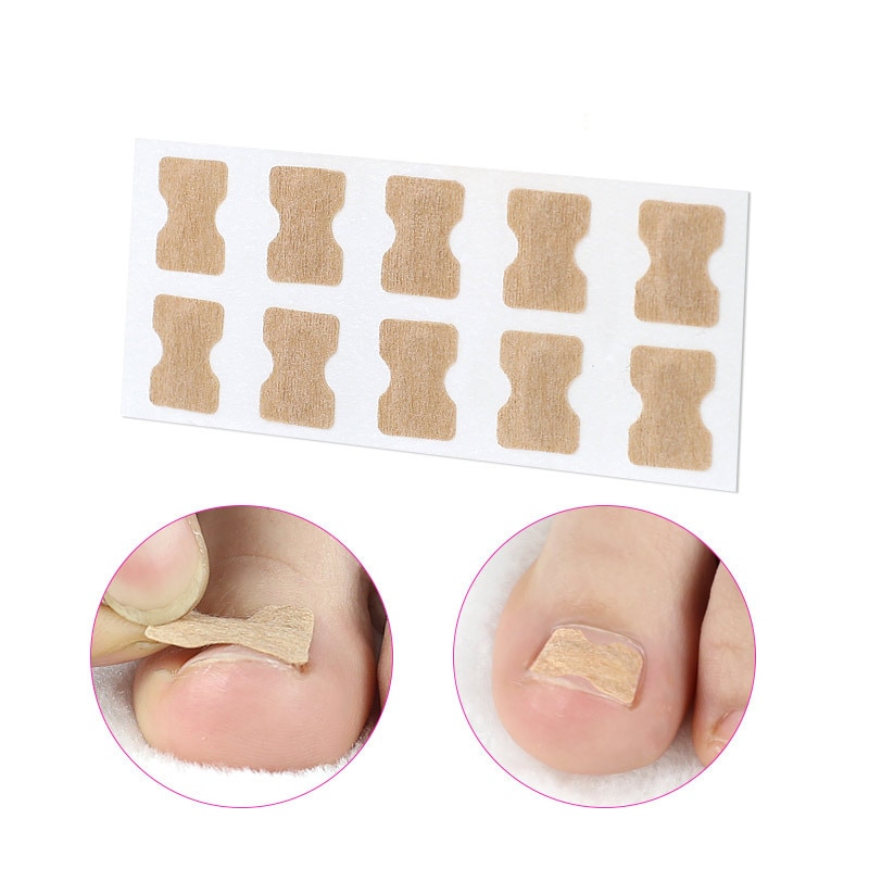 Ingrown Toenail Corrector Sticker Nail Strip Anti-roll Nail Free Glue ...