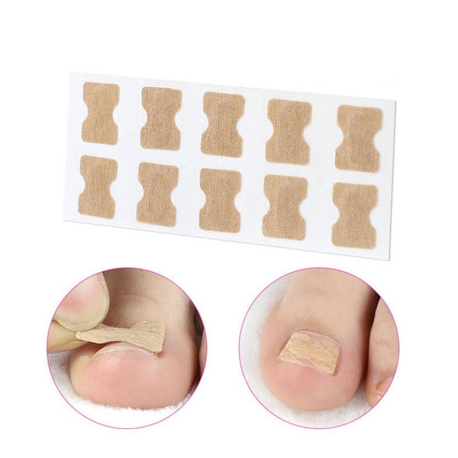 Ingrown Toenail Corrector Sticker Paronychia Treatment Fixer Recover ...