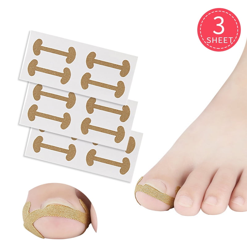 Ingrown Toenail Corrector Stickers Paronychia Treatment Pedicure Toe ...