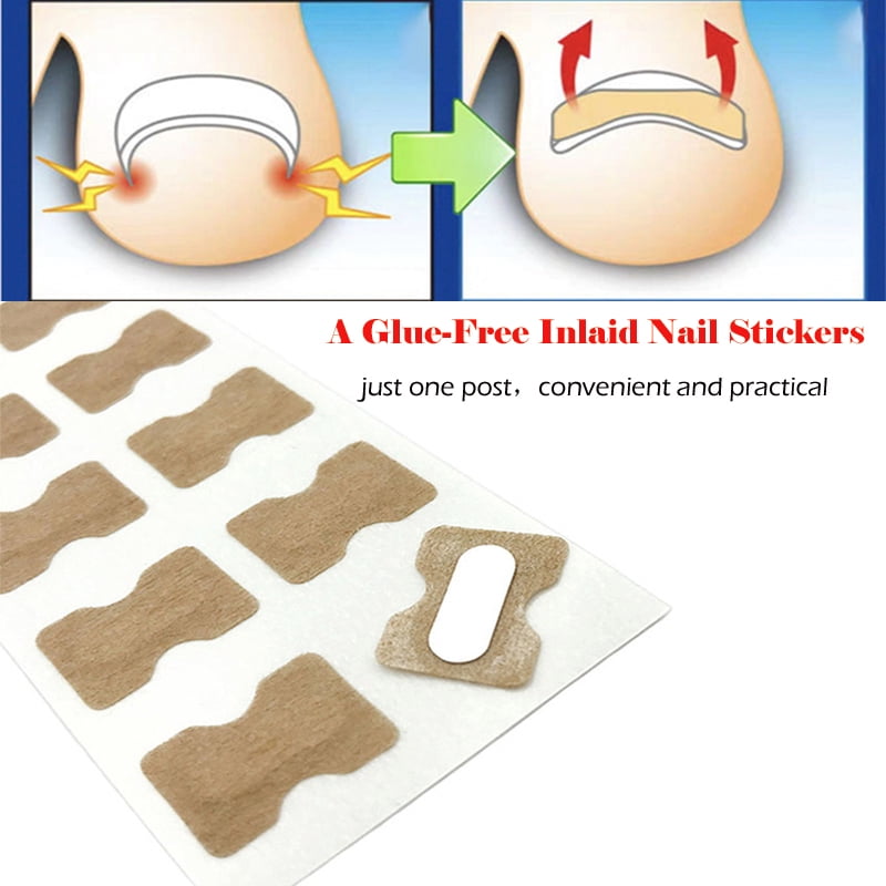 Ingrown Toenail Corrector Stickers Paronychia Treatment Pedicure Toe ...