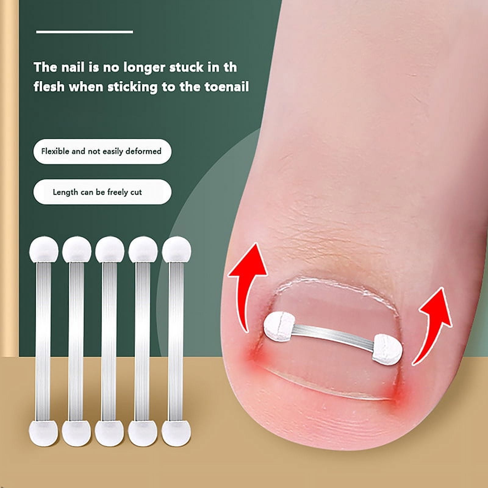 Ingrown Toenail Corrector Tools Pedicure Recover Embed Toe Nail ...