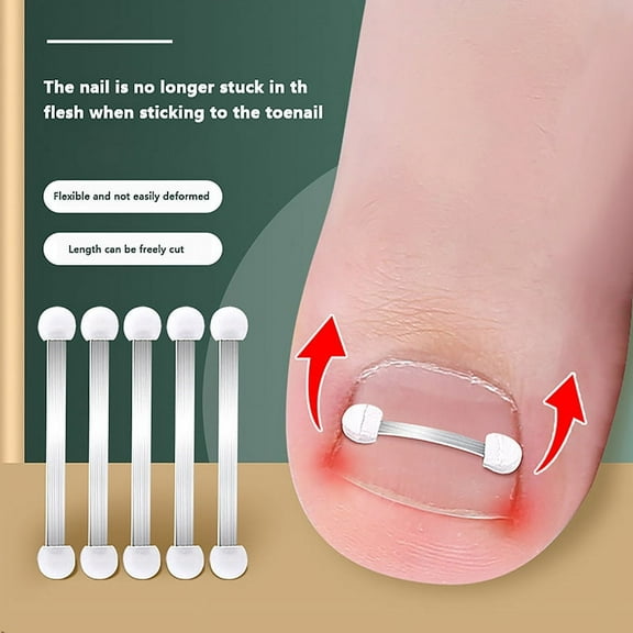 CurveCorrect Ingrown Toenail Corrector Kit, 10 Braces, Pain Relief ...