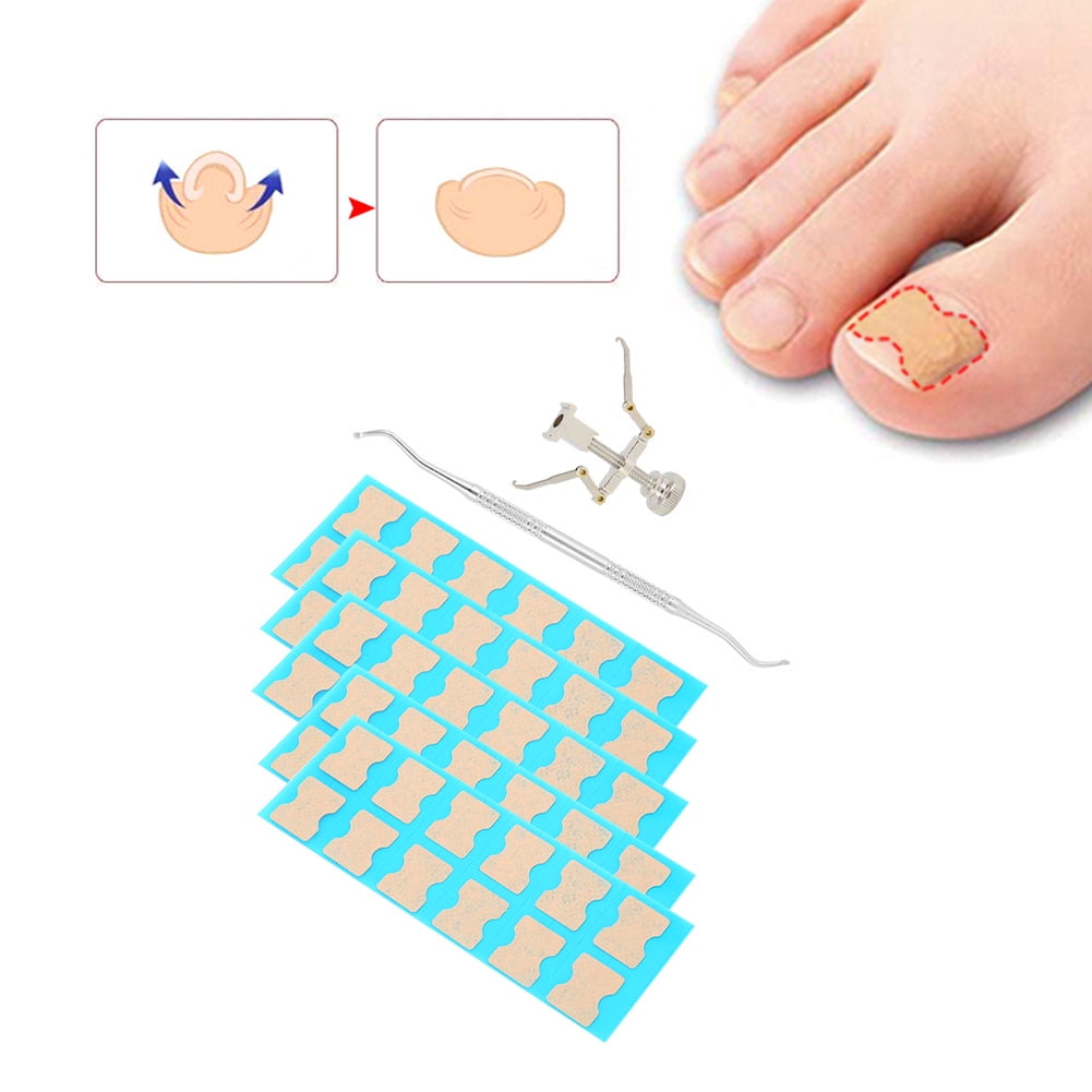 Ingrown Toenail Patch,Ingrown Toenail Correction Patch Ingrown Nail ...