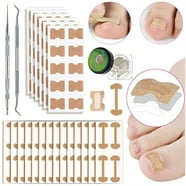 OTVIAP Ingrown Toenail Fixer Adjustable Toe Nail Paronychia Corrector ...