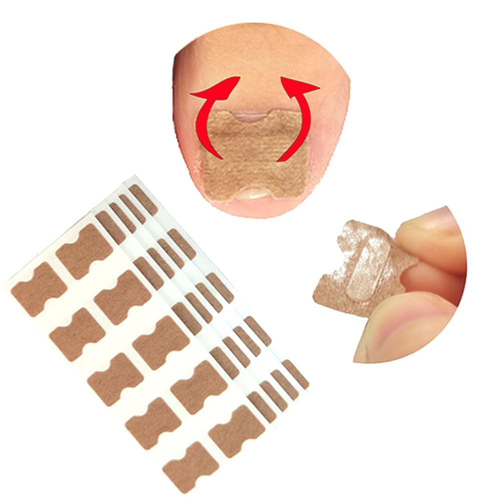 Ingrown Toenail Treatment, 50pcs Ingrown Toenail Correction Stickers ...