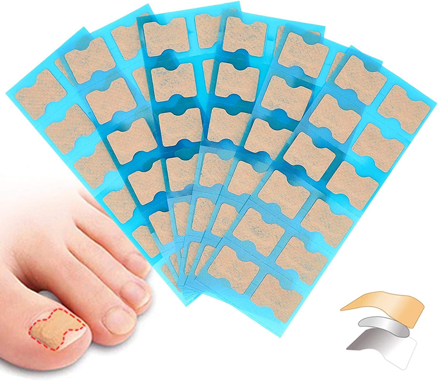Ingrown Toenail Treatment, Nail Patch, Ingrown Toenail Corrector ...