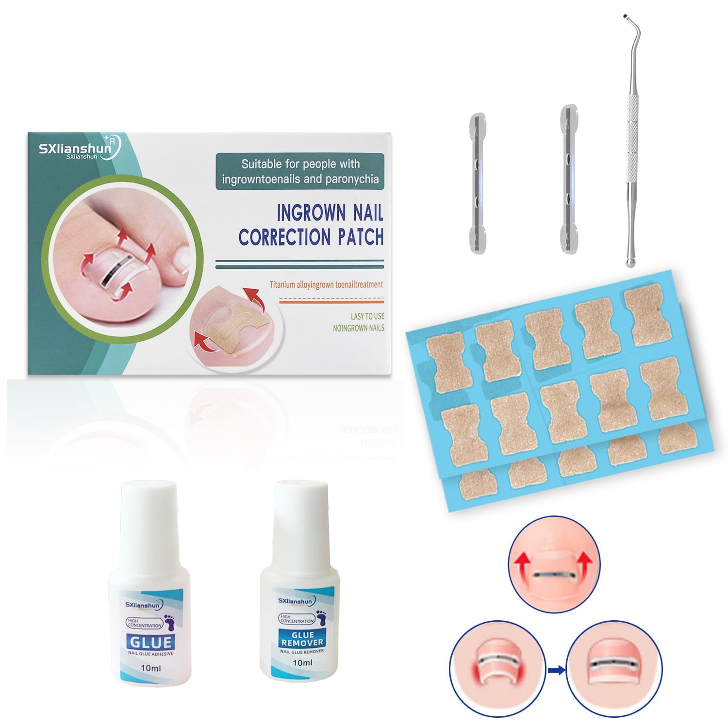 Ingrown Toenail corrector & Tool Set, curve correct ingrown toenail ...