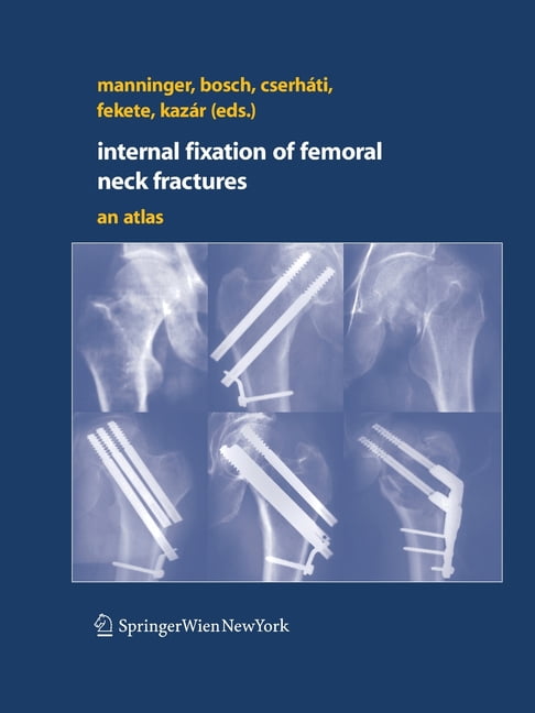 Internal Fixation of Femoral Neck Fractures: An Atlas, (Paperback ...