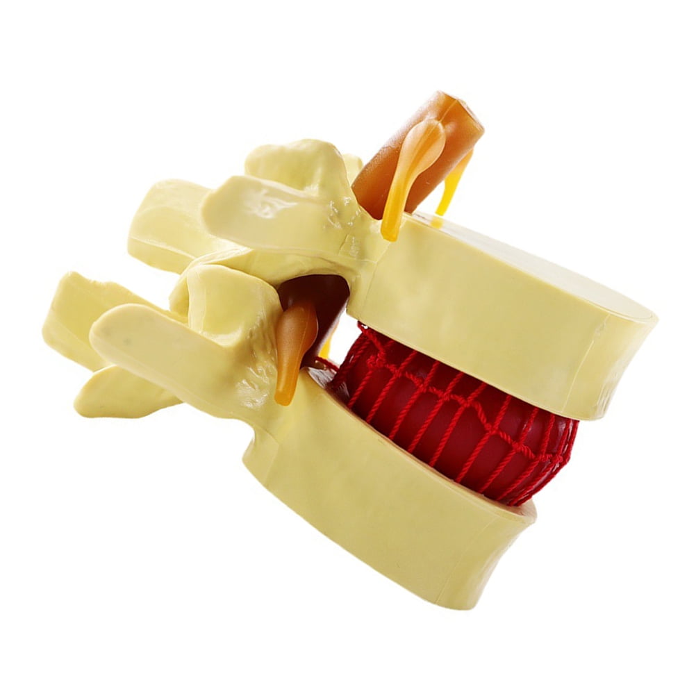 Yellow PVC Skeleton Model for Teaching Lumbar Disc Herniation with ...