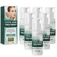Jaysuing Salicylic Acid Cystic Acne Cream Removes Acne Acne Closed