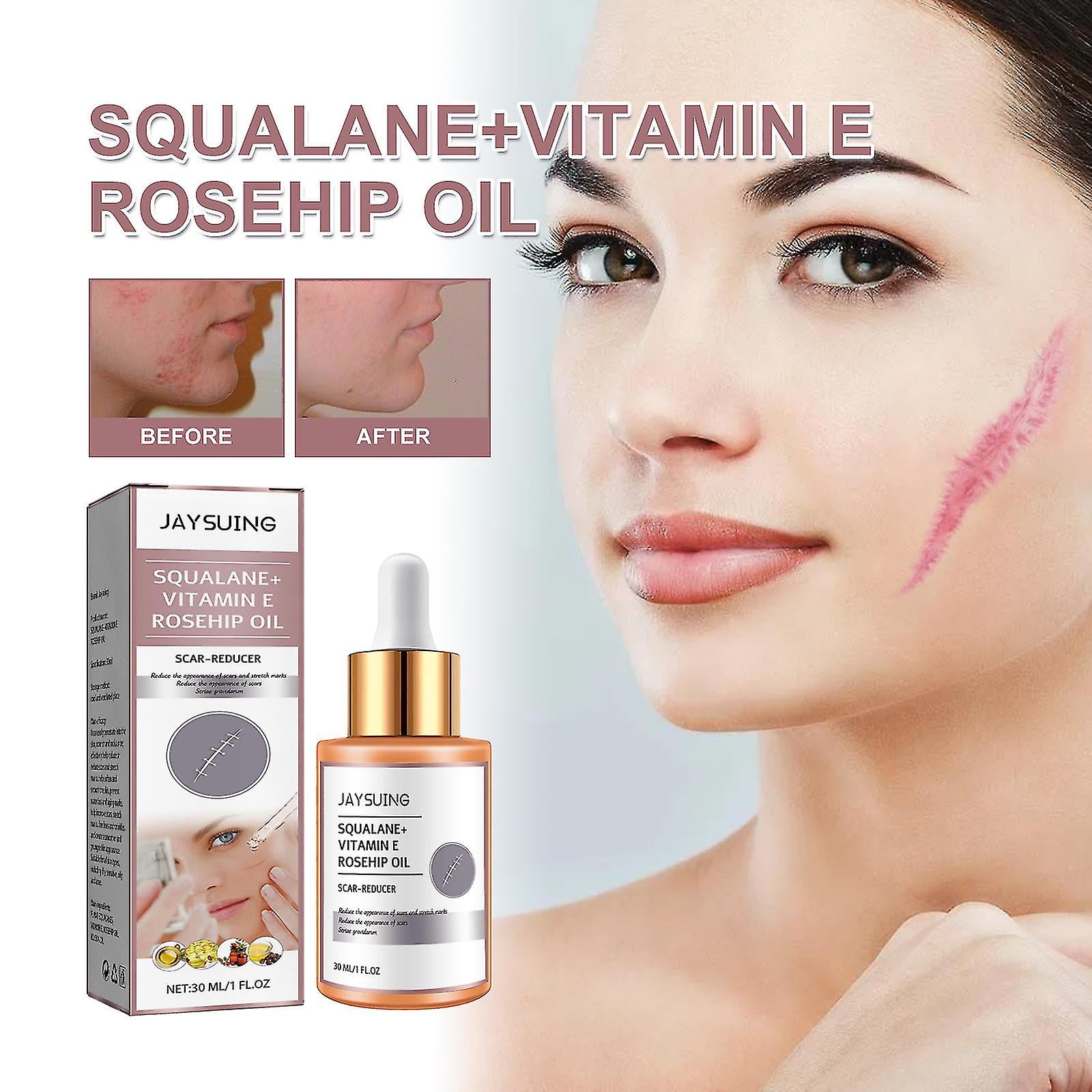 Jaysuing Squalane + Vitamin E Rosehip Oil fades caesarean section scars ...
