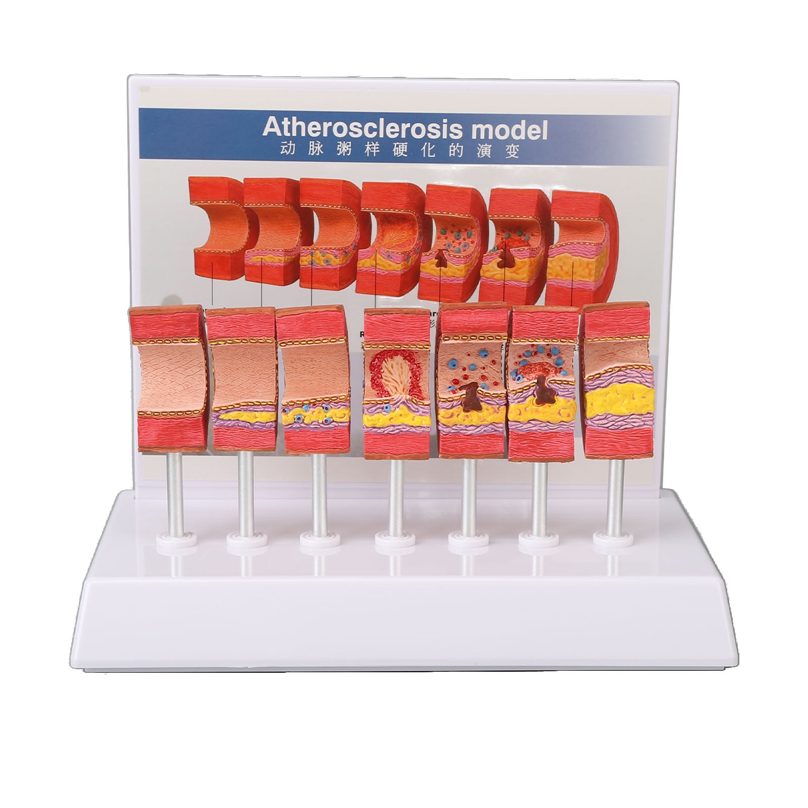 KUAA 7PCS Artery Anatomy Model Anatomical Vessel Atherosclerosis ...