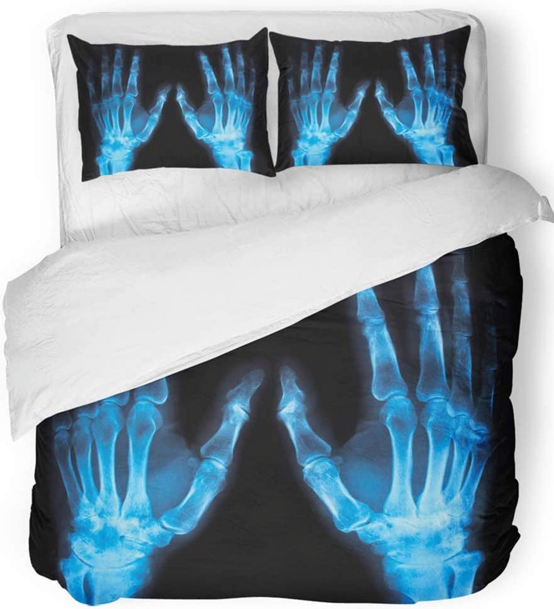 KXMDXA 3 Piece Bedding Set Radiography X Ray of Both Human Hands Ailing ...