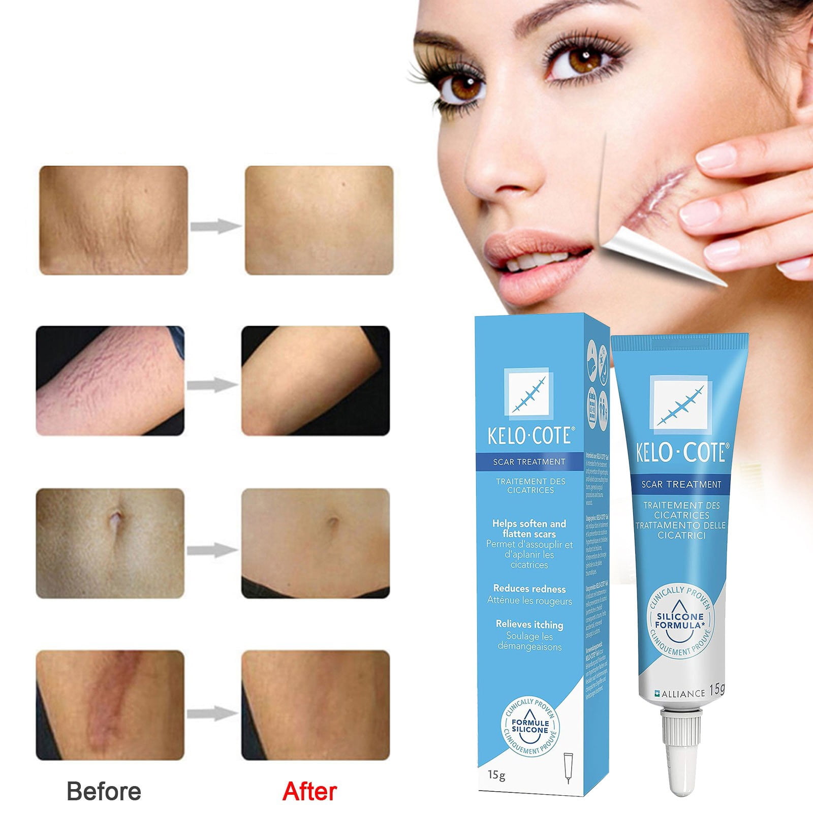 Kelo-Cote Advanced Silicone Scar Gel 15g – Keloid & Hypertrophic Scar ...