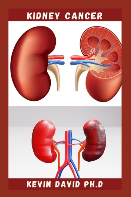 Kidney Cancer: Step By Step Guide On How To Heal Your Kidney And Live ...