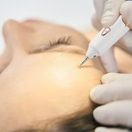 Tanda Zap Acne Spot Treatment Device - Walmart.com