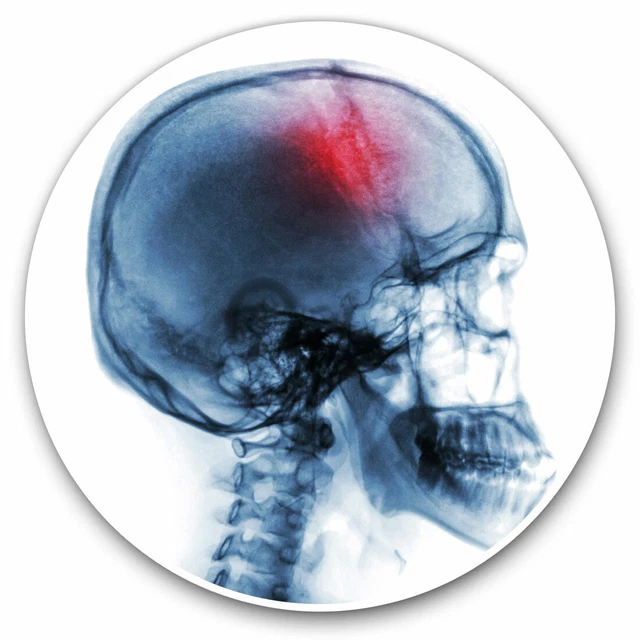 Kira Sticker With Stroke Victim Skull X Ray Medical Doctor Student Cool ...