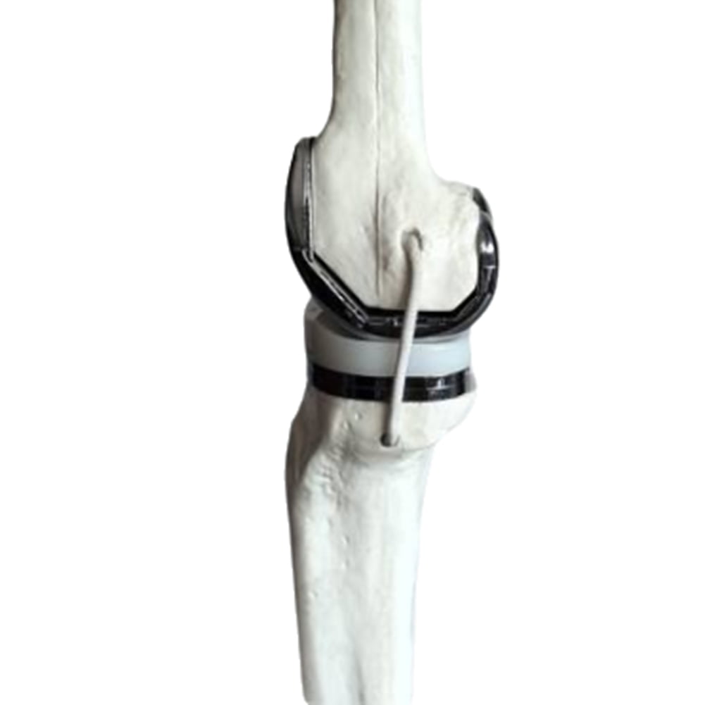 Knee Joint Model Simulation Replacement Surgery Meniscus Ligament ...