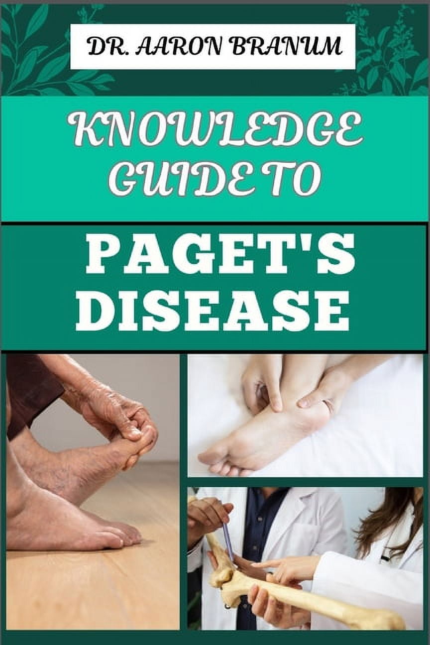 Knowledge Guide to Paget's Disease: Essential Manual To Symptoms ...