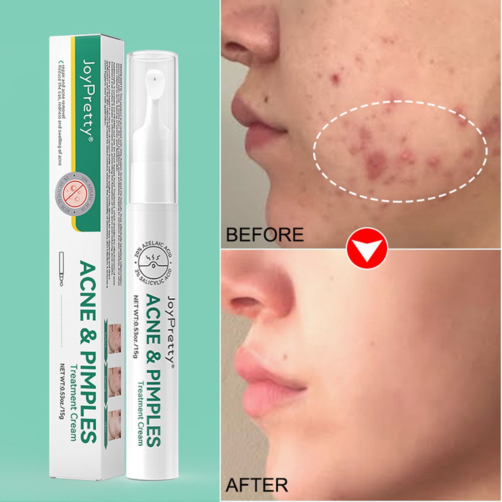 Kokovifyves Beauty Products Sale Herbal Acne Removing Cream,Herbal Acne ... Kokovifyves Beauty Products Sale Herbal Acne Removing Cream,Herbal Acne ...