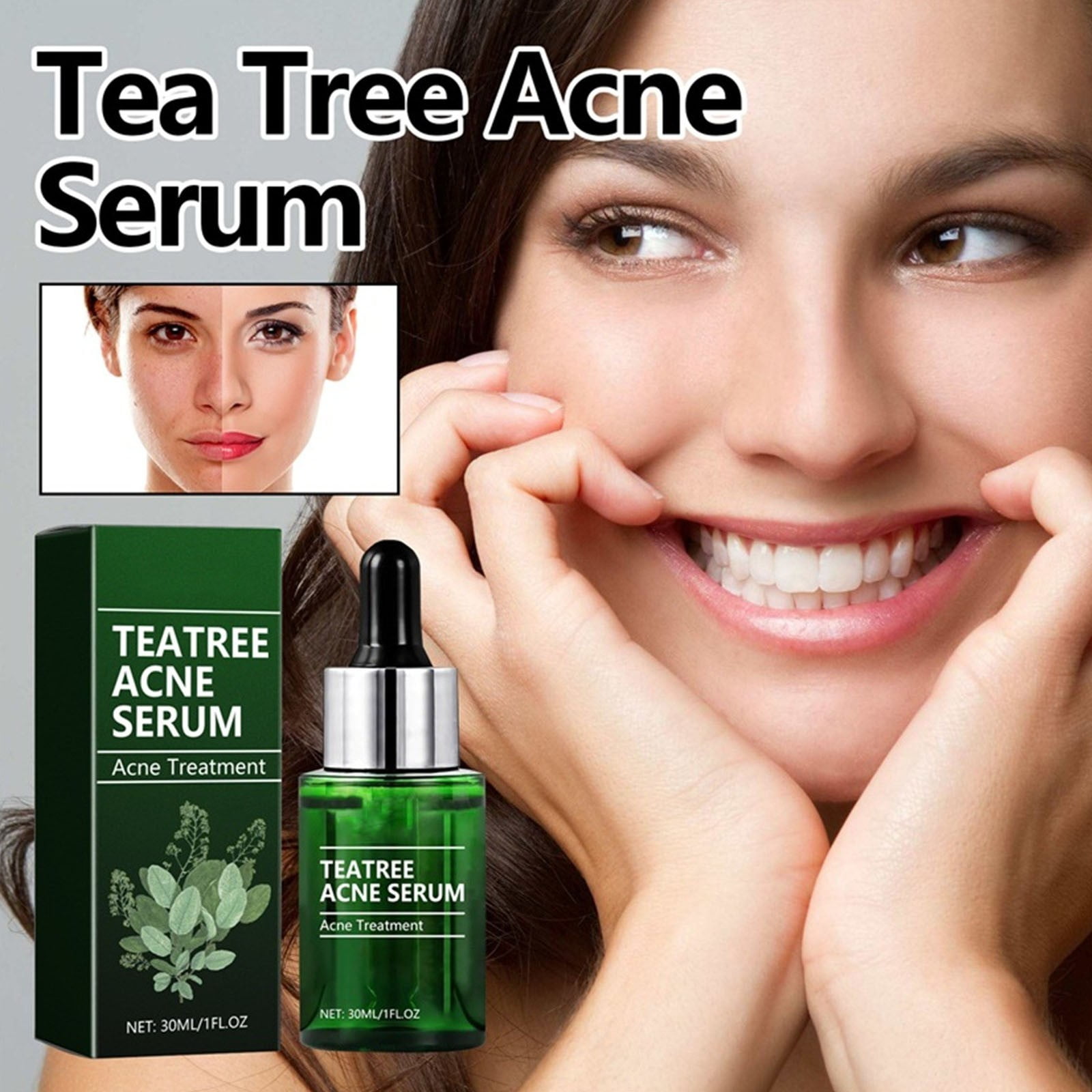 Komiseup Tea Tree Oil Acne Serum Treatment Acne Prone Sensitive Skin Care Face Serum To Cystic
