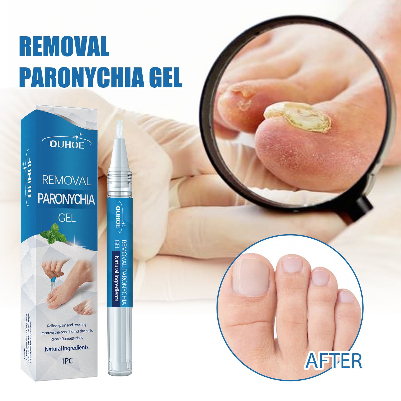 LAOSR Nail Fungal Liquid Pen Onychomycosis Paronychia Toe Fungus Hand ...