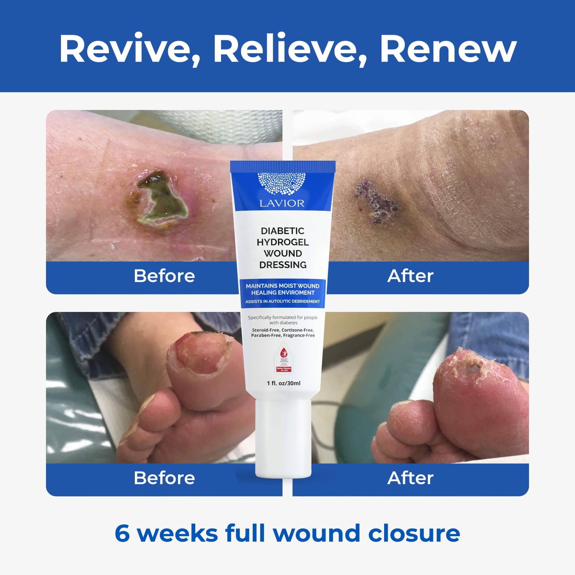 LAVIOR - Diabetic Hydrogel (1oz): Trusted Relief for Foot & Leg Ulcers ...