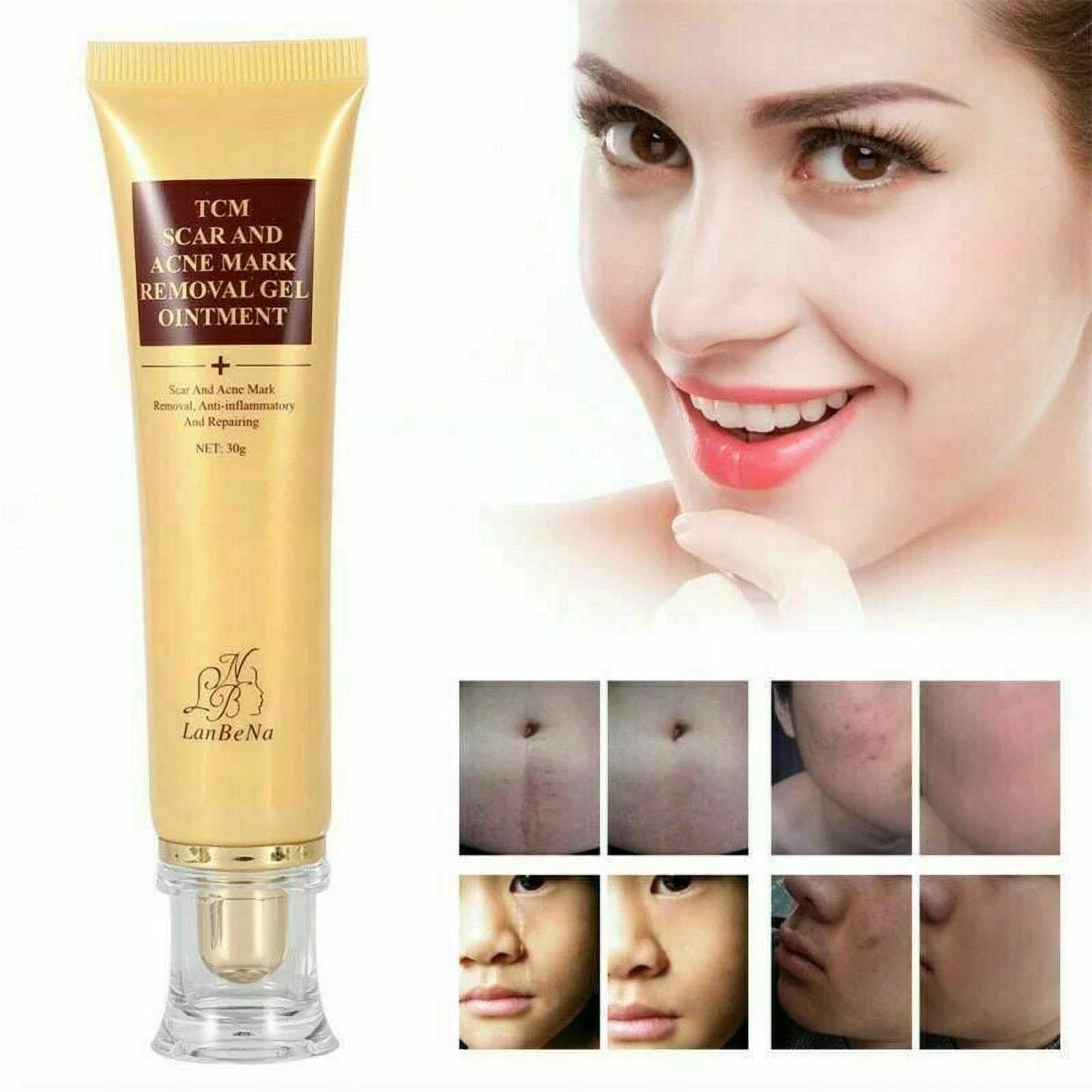 Venicare LanBeNa Pimple Scar Acne Mark Removal Gel, Herbal Treatment ...