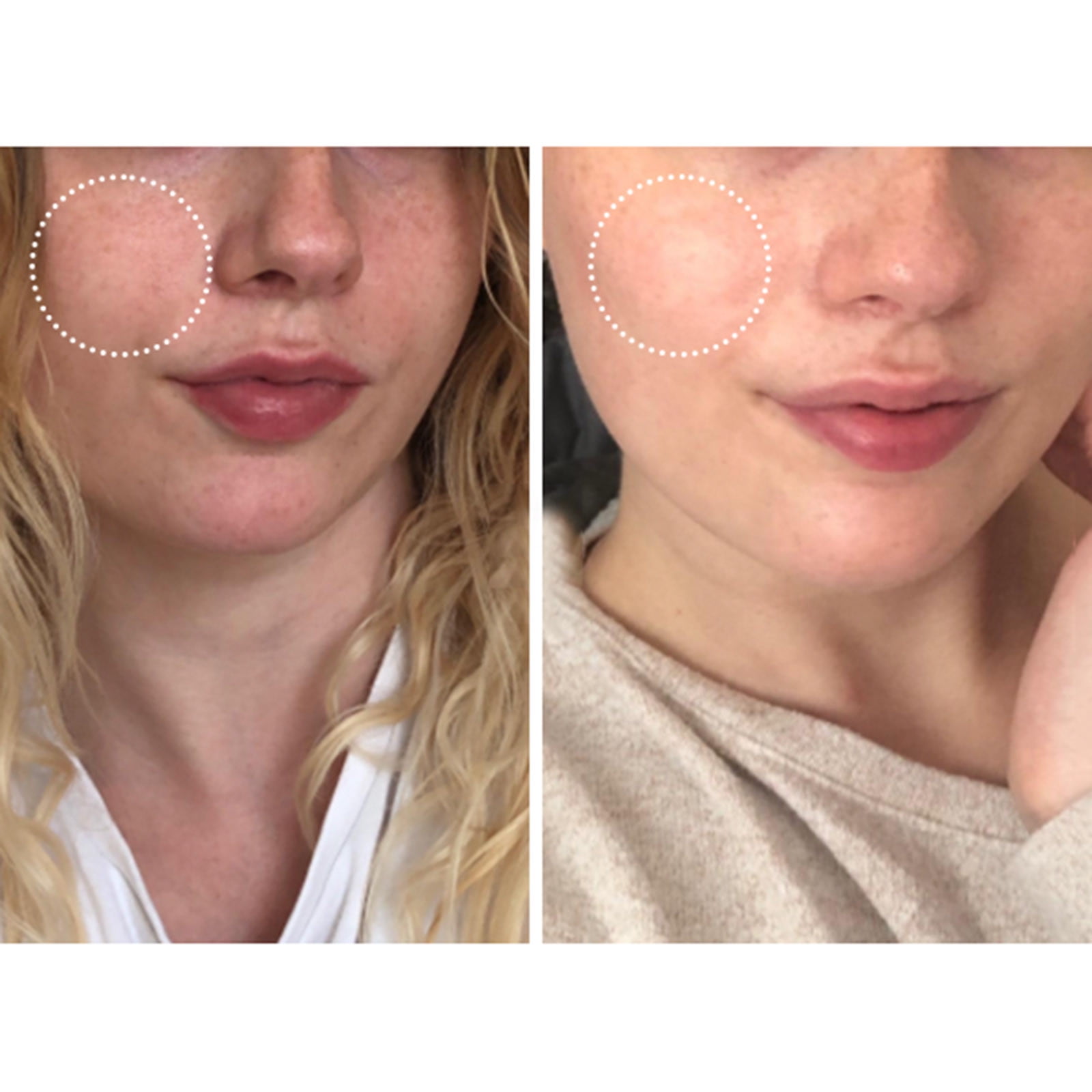 Line Filler Chin Firming Device Project Jawline Night for Face Dry Skin ...