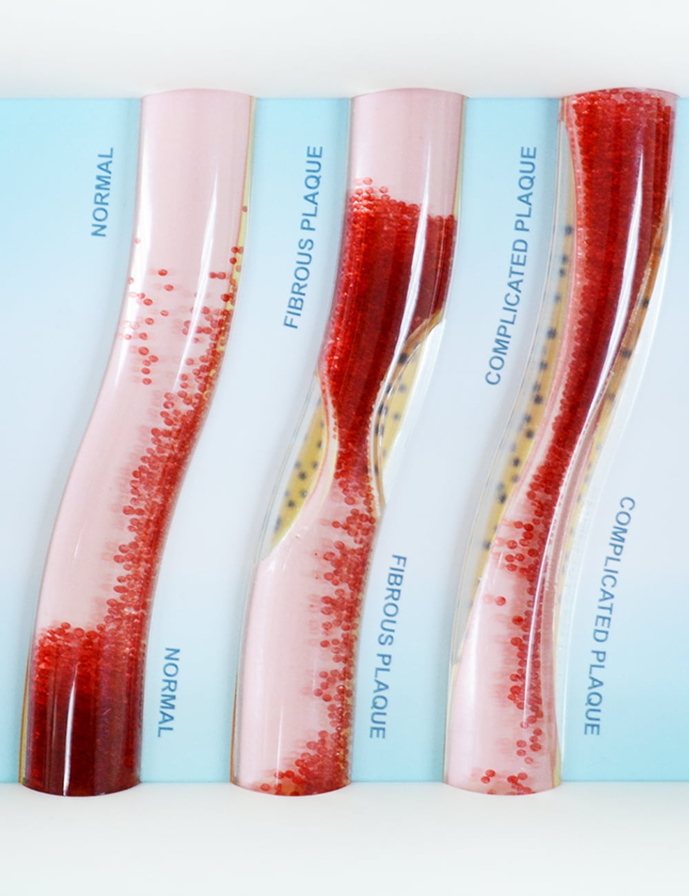 Low-Density Lipoprotein LDL Blood Vessel Model for Medical Patient ...