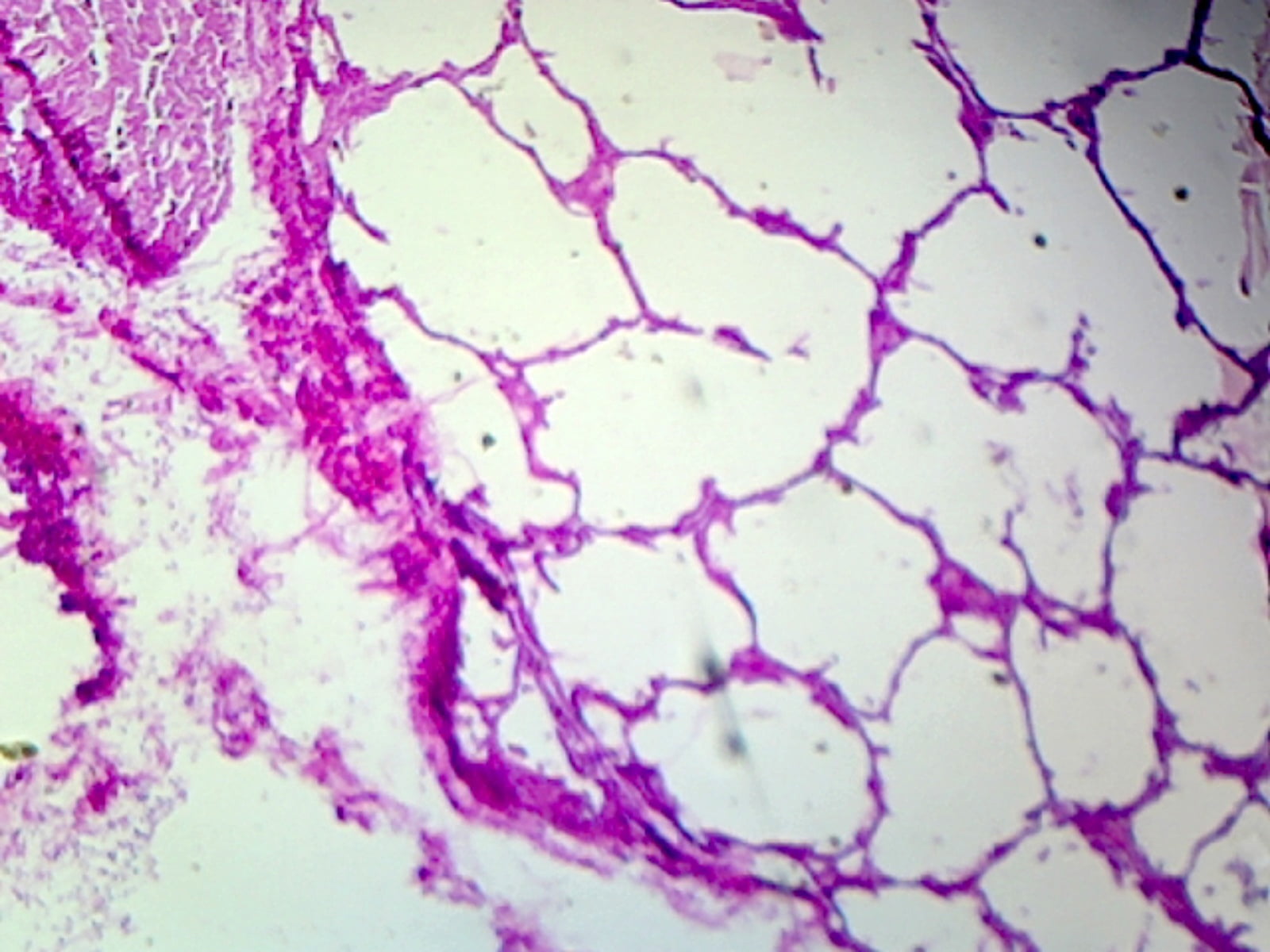 Lung of a Smoker, Human; Showing Alveoli; Section by Go Science Crazy ...