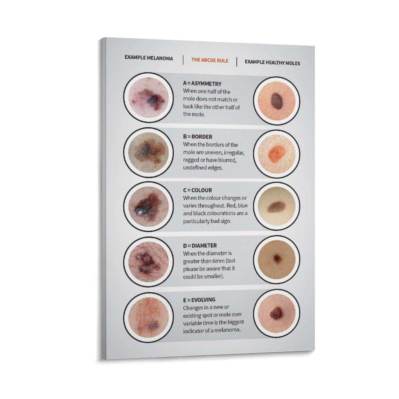 MALIGNANT MELANOMA Dermatology Education Chart Wall Art Posters For ...