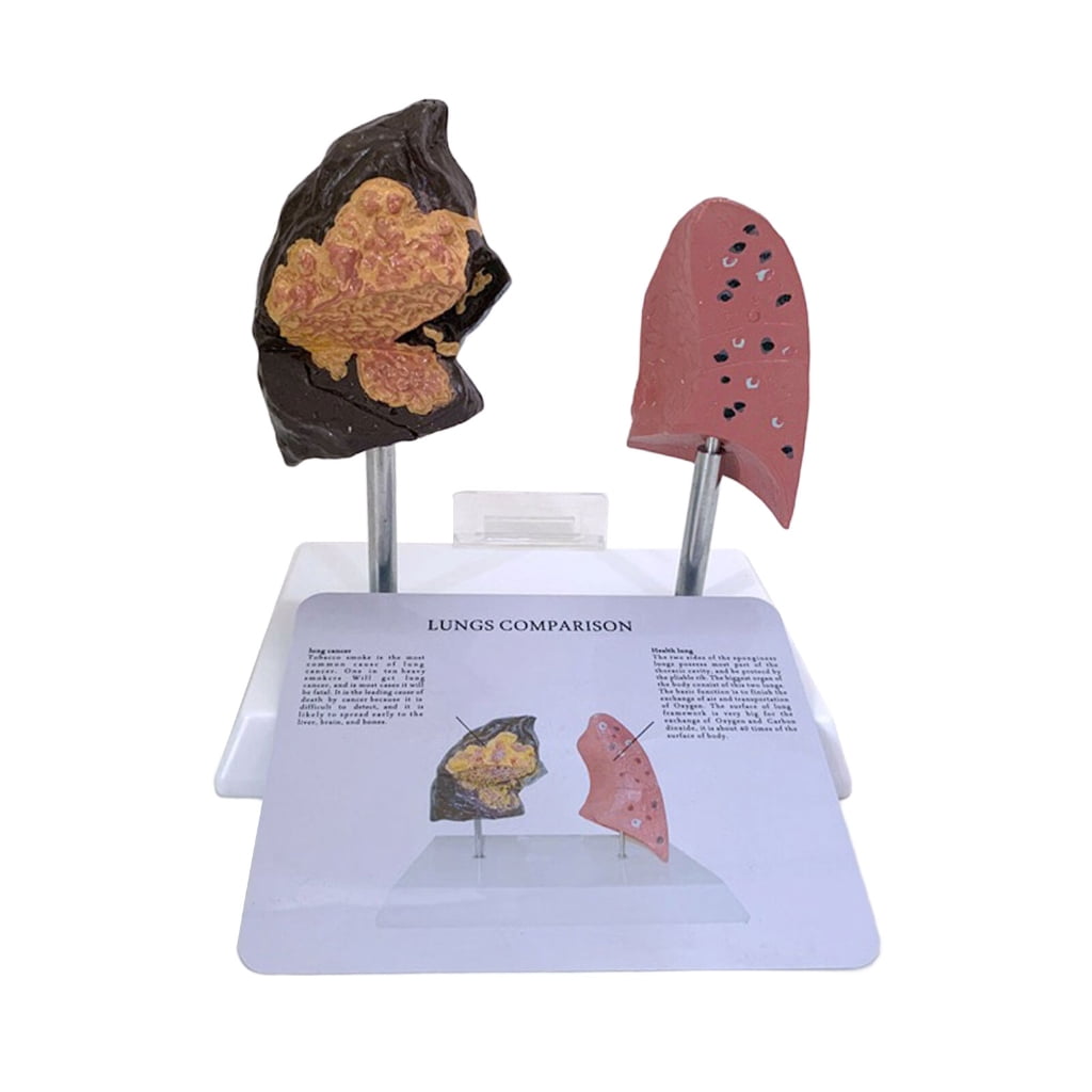 MOMOJIA Smoker And Healthy Lung PVC Anatomical Model Detailed Clinical ...