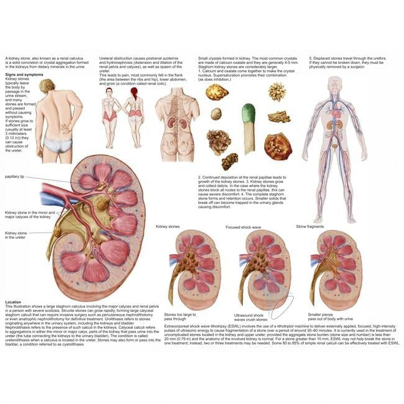 Medical chart showing the signs and symptoms of kidney stones Poster ...