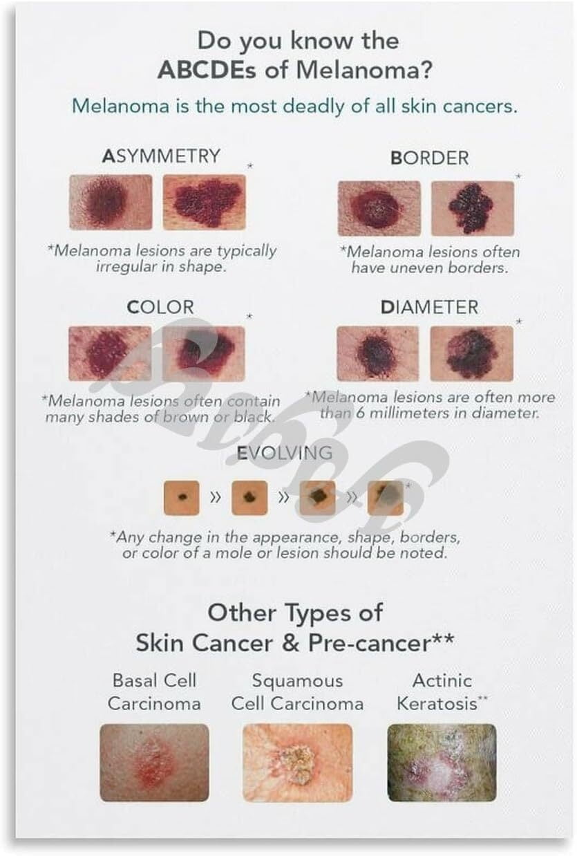 Melanoma Posters Dermatology Education Chart (4) Canvas for Bedroom ...