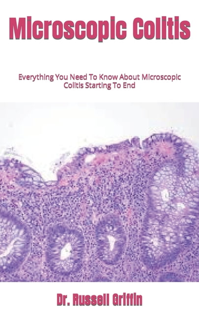 Microscopic Colitis: Everything You Need To Know About Microscopic ...