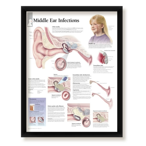 Middle Ear Infections Framed Medical Educational Informational Poster ...
