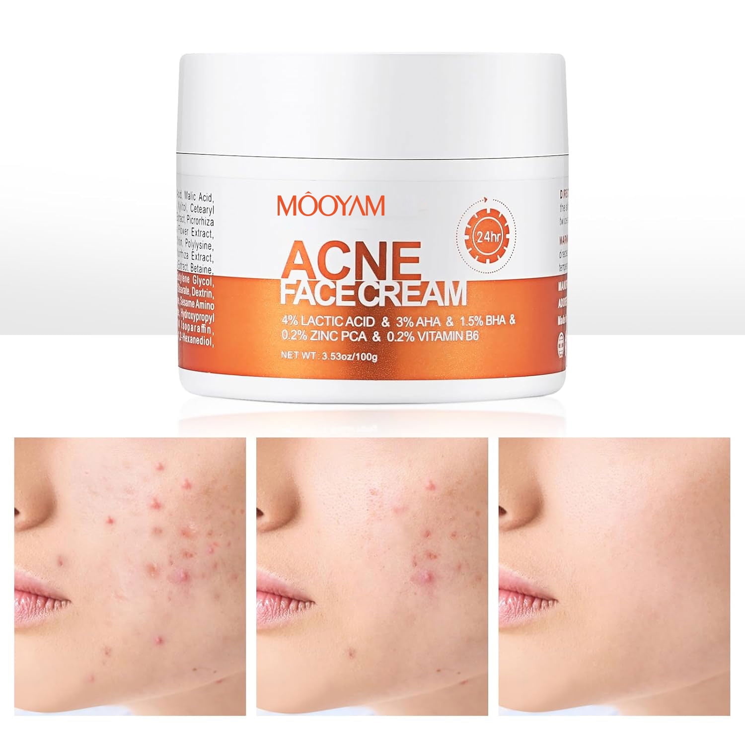 Mooyam Tea Tree Oil Face Cream Acne Cream - for Oily, Acne Prone Skin ...
