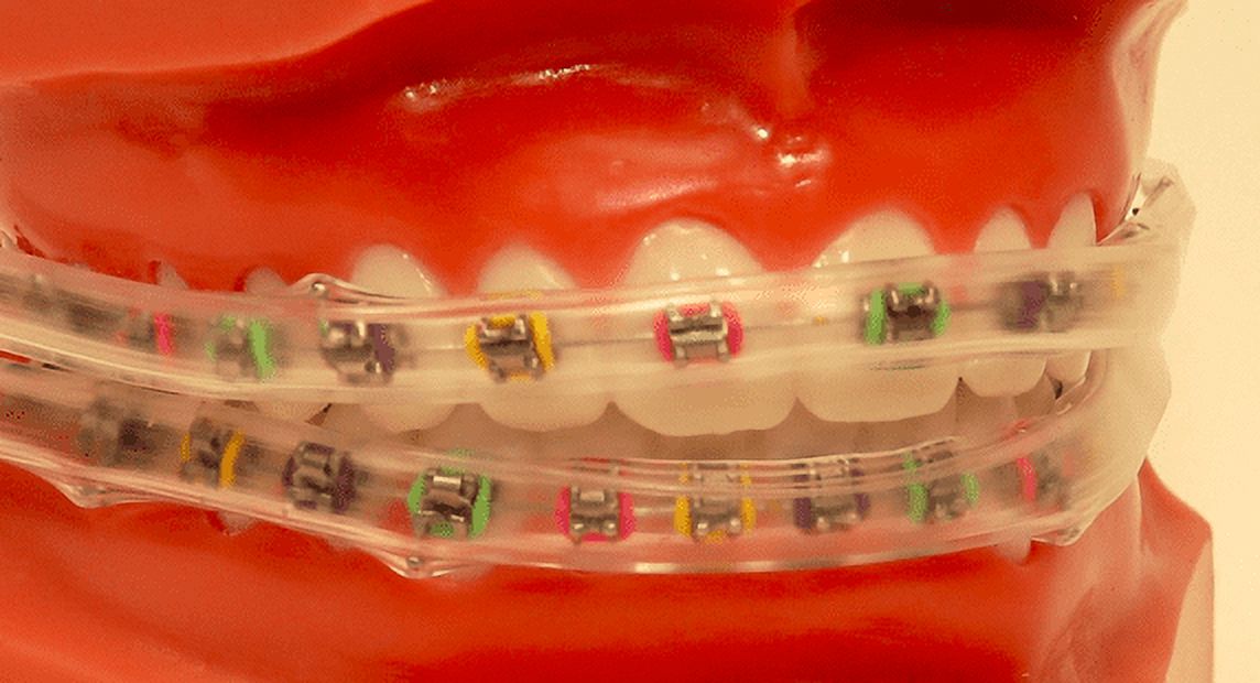 Polident Proguard & Retainer Daily Cleansing Tablets, Mouth Guard ...