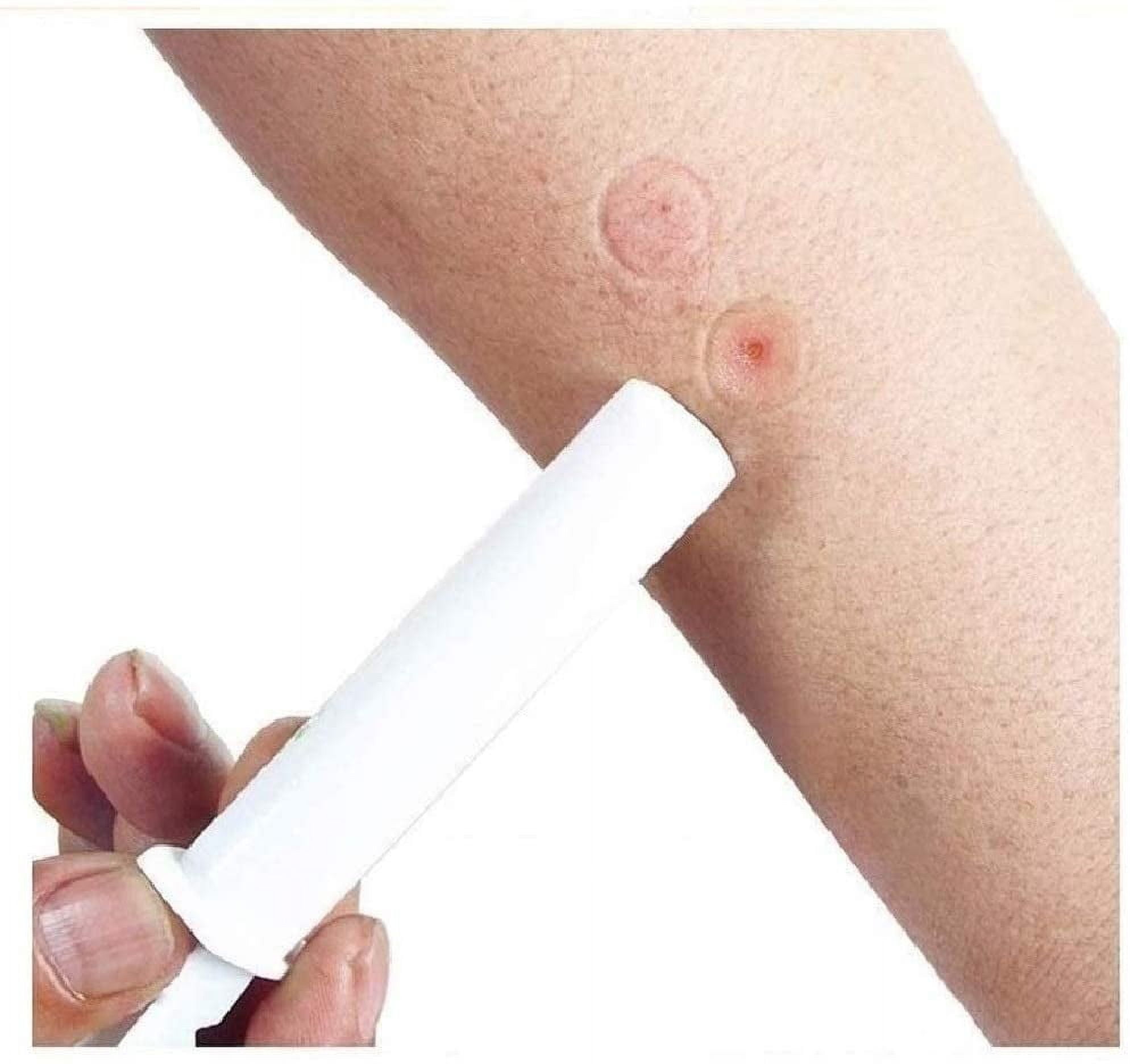 Mosquito Bee Bite Sting Kit Suction Tool - Safety First Aid Supplies ...