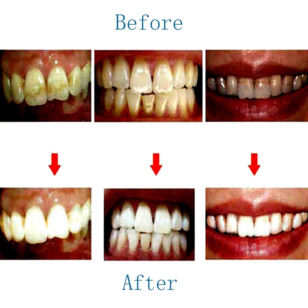 Mouth Protection Healthy Teeth Oral Care Dental Protection Toothpaste ...