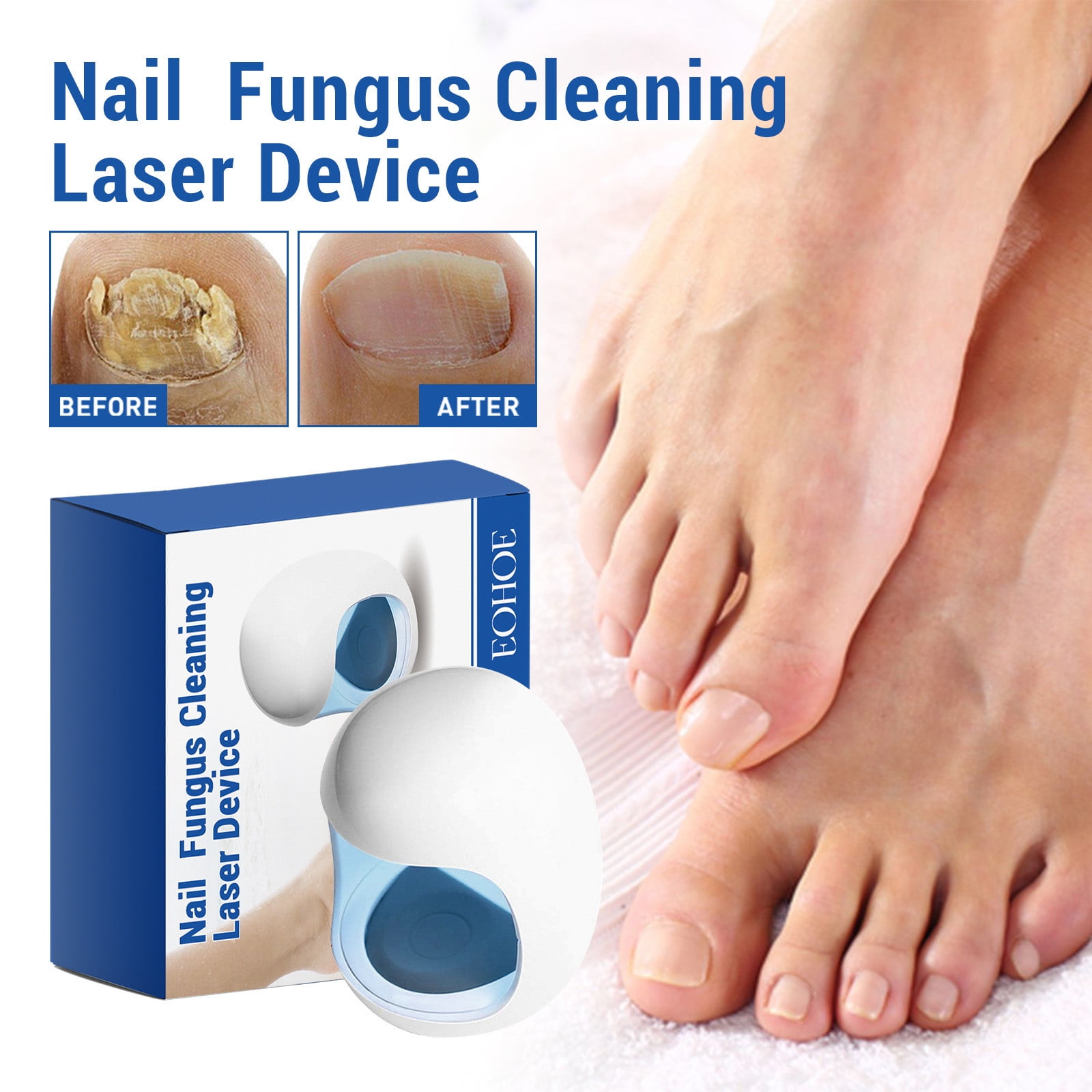 Nail Fungus Cleaning Laser Device, Nail Fungus Laser Treatment for ...