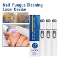 Nail Fungus Cleaning Laser Pen,Nail Fungus Cleaning Laser Device Nail ...